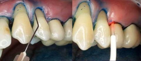 Helbo-Therapie Wie Sie funktioniert & weitere wichtige Infos