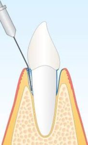 Helbo-Therapie Wie Sie funktioniert & weitere wichtige Infos